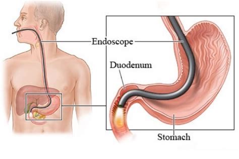 Understanding Oesophago Gastro Duodenoscopy Ogd And Colonoscopy