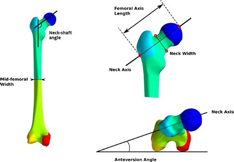 Femoral Neck Shaft Angle And Femoral Neck Anteversion Mlifer Ortho