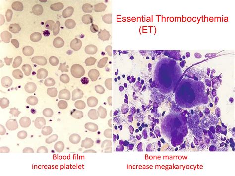 Mpns Definition Types Of Mpn Mutations Aetiology Clinical Features Cml Ppt