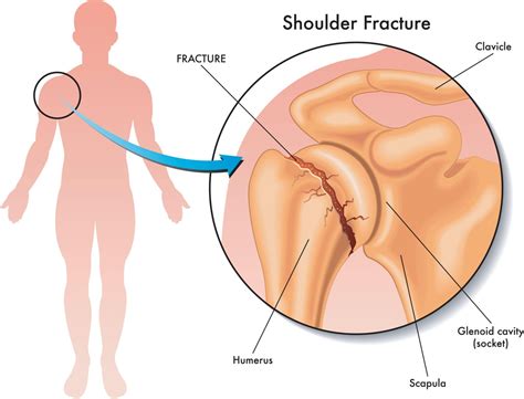 Shoulder Fractures Shoulder Specialist Singapore