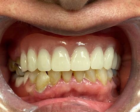 What Are The Most Common Upper Denture Problems