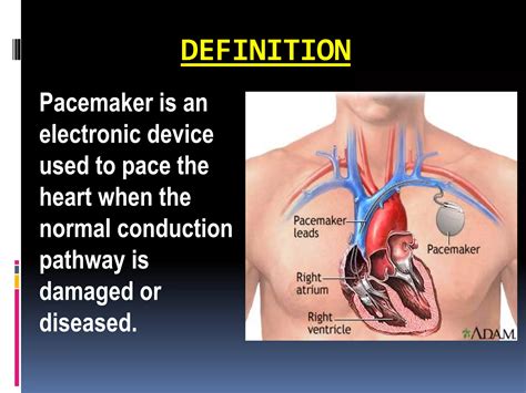 Pacemaker Powerpoint Presentation Med Surg Pptx