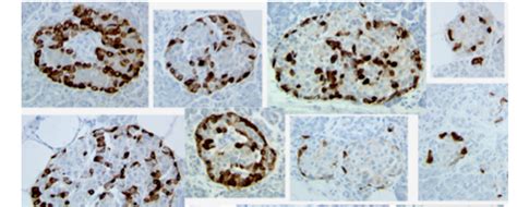 Role Of Beta Cell Function In Diabetes Consultant360