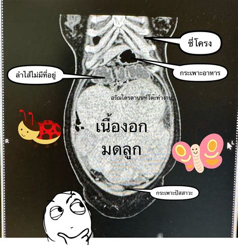 ก้อนเนื้องอกมดลูกปล่อยไว้ 12ปี อรัณ ไตรตานนท์ โต๊ะทำงาน