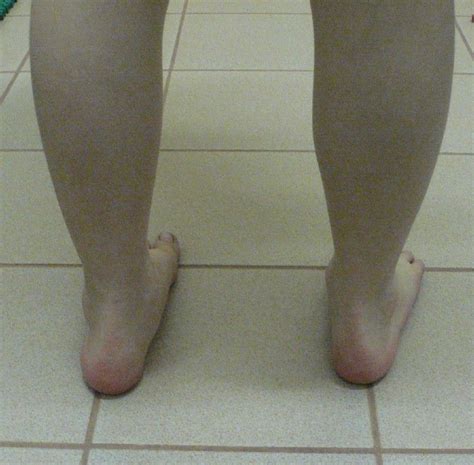 Skew Foot Dr Michael Vitek Vienna