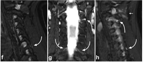 A Sagittal Stir B Sagittal T2 Weighted C Sagittal T1 Weighted