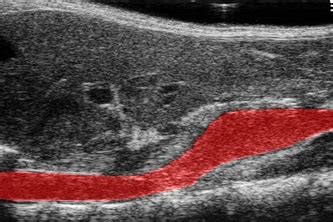 Aneurysm Detection With MaskRCNN Devpost