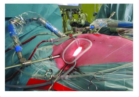 The Set Up For A Minimally Invasive Port Access Approach Through A Download Scientific