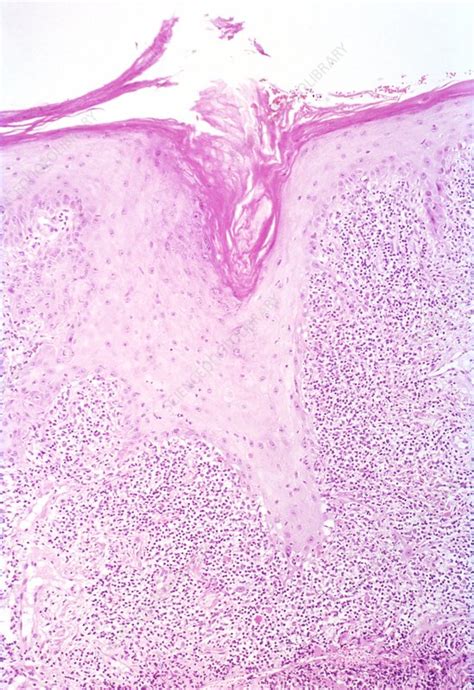 Lichen Planus Light Micrograph Stock Image C0042936 Science