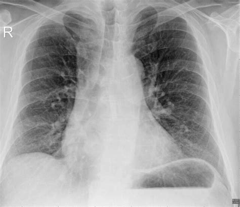 Radiopaedia Case Implantable Loop Recorder Id 50967 Study 56508 Nc Commons Radiopaedia Case Implantable Loop Recorder Id 50967 Study 56508 Nc Commons