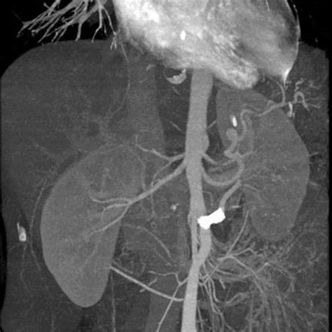 Endoscopy Images Shown Are A The Mass In The Appendix And The