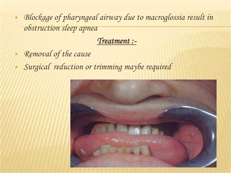 Diseases Of Tongue Pptx