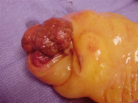 Intussusception Surgery Photos