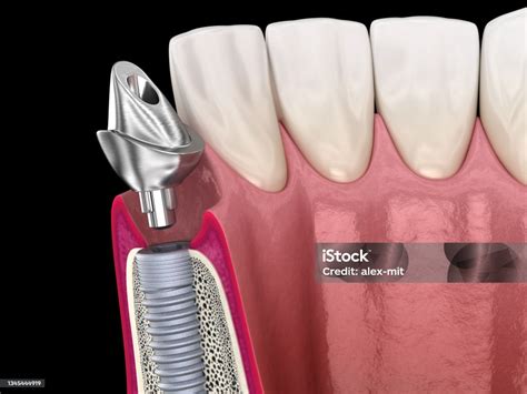 맞춤형 임플란트 부속 치과 임플란트 및 세라믹 크라운 의학적으로 정확한 치아 3d 그림 치아 임플란트에 대한 스톡 사진 및 기타 이미지 Istock