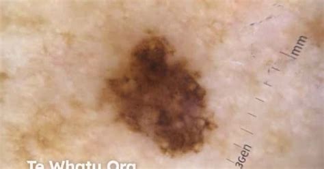 Superficial Spreading Melanoma Image