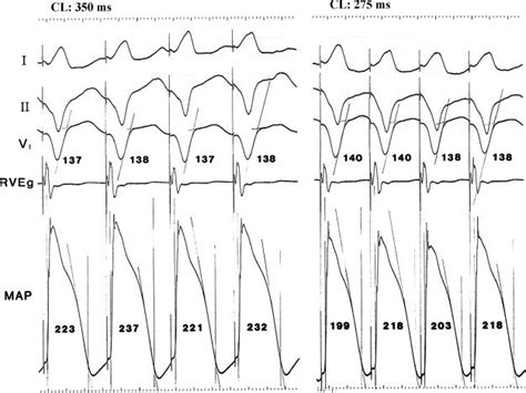 Monophasic Action Potential Map Recorded From The Right Ventricle Download Scientific Diagram