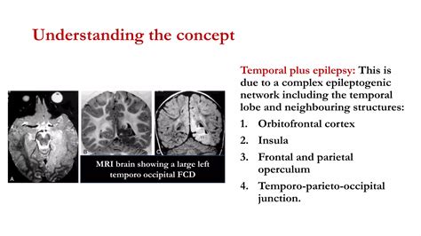 Temporal Plus Syndrome Pptx