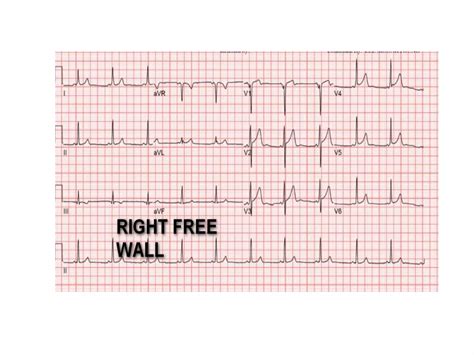 Localization Of Wpw Accessory Pathway By Surface Ecg Pptx