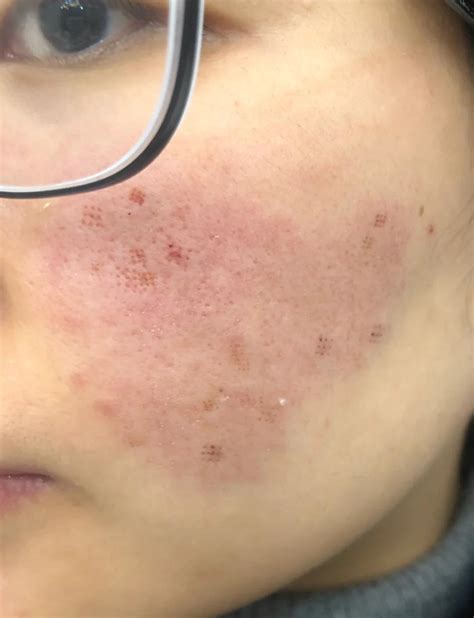 激光美容：全脸点阵与皮下剥离的亲身经历