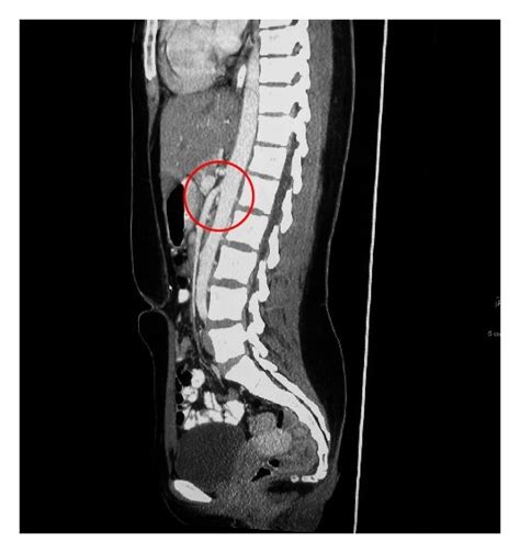 How To Measure Aortomesenteric Angle At Lewis Holt Blog