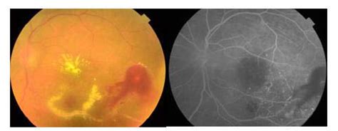 Figure 2 From Acute Retinal Necrosis A Potentially Visual Devastating