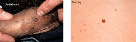 Skin Tags On Scrotum Causes