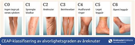 Fakta Om åreknuter Hvorfor Får Man åreknuter Åreknuteklinikkene