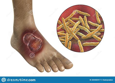 Buruli Ulcer On A Patient Foot 3d Illustration The Disease Caused By