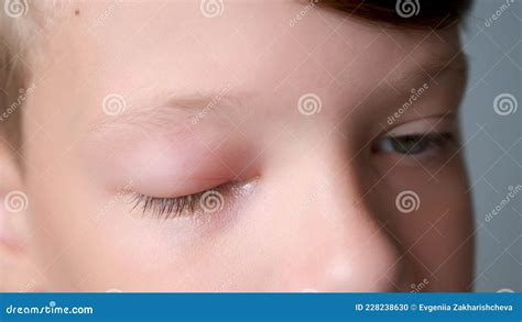 Bug Bite Swelling On Face