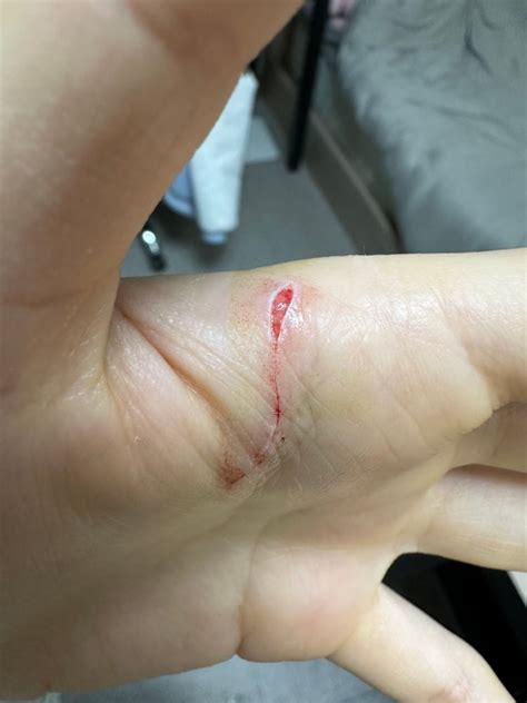손 찢어진 상처 지식in