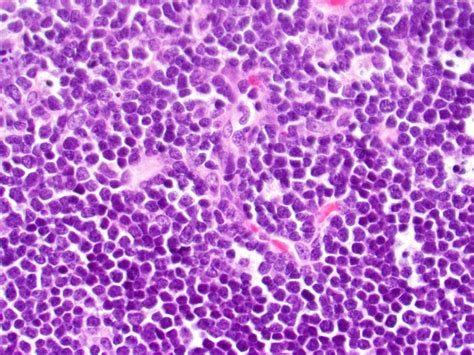 Pathology Outlines Acute Lymphoblastic Leukemia Lymphoma
