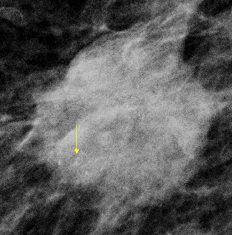 Breast And Axilla 52 Malignant Breast Lesions Case 522 Breast