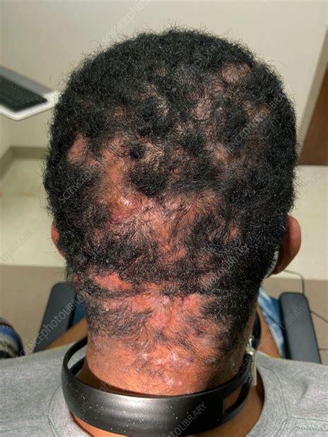 Dissecting Cellulitis Stock Image C056 0498 Science Photo Library