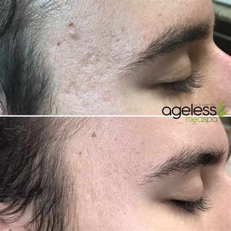 Pixel 8 Rf Microneedling Ageless Medspa By Dr Sypien Chicago Il