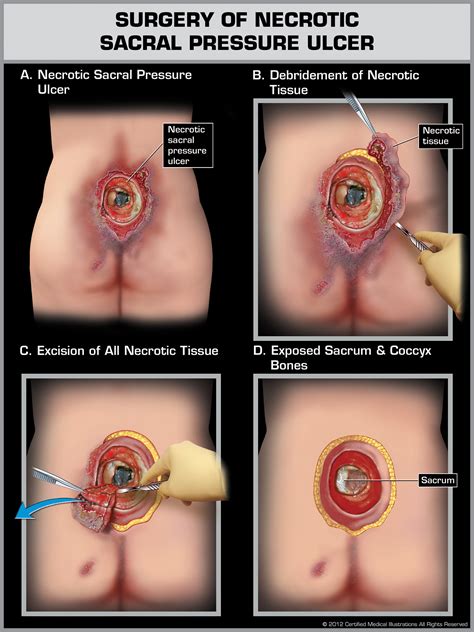 Sacral Pressure Ulcers In Nursing Homes Nj Neglect Lawyer