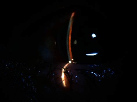 Gas Expansion Three Days After Pars Plana Vitrectomy With Sulfur