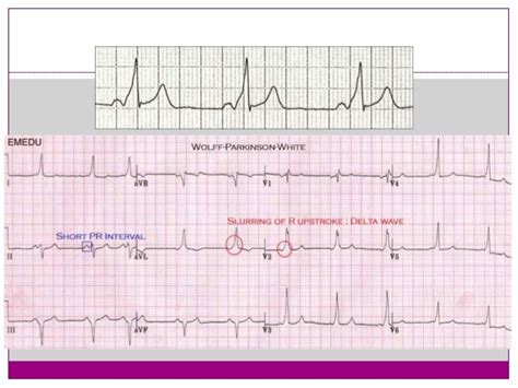 Basic Of Pre Excitation Syndrome