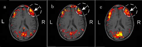 Correlation Maps Obtained By Temporal Correlation Of Bold Fmri Signal