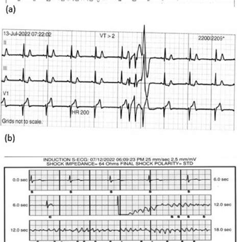 Resuscitation Council Algorithm For Adult Tachycardia With Pulse Download Scientific Diagram