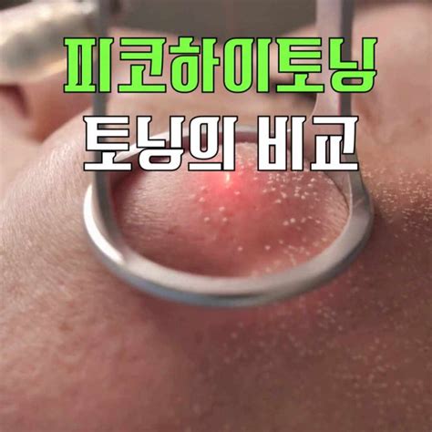범계 피코하이토닝vs피코 레이저토닝 차이점과 후기광고x 네이버 블로그