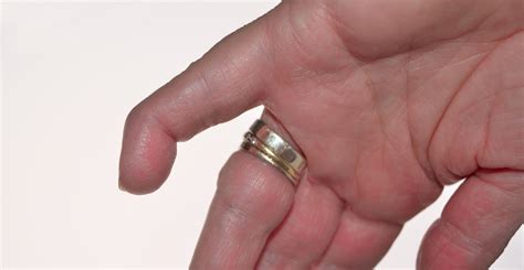 Mallet Finger Plymouth Bay Orthopedic Associates Inc