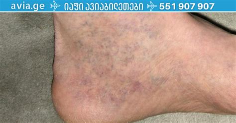 შინ ყველას მოეპოვება ვარიკოზის საწინააღმდეგო ეს საშუალება მაგრამ არავინ იცის ამის შესახებ