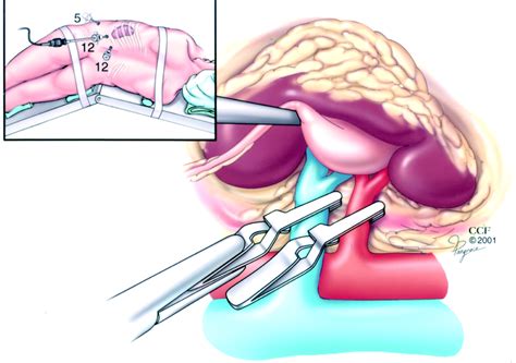 Retroperitoneal Laparoscopic Radical Nephrectomy Medigoacademy