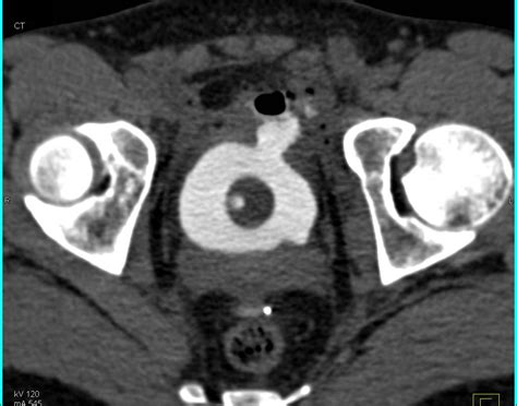 Ct Cystogram With Bladder Leak Sp Pelvic Trauma Genitourinary