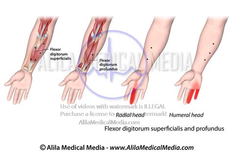 Flexor Digitorum Profundus And Superficialis