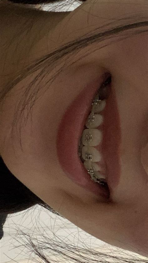 Braces Perfect Teeth Teeth Aesthetic Braces Colors