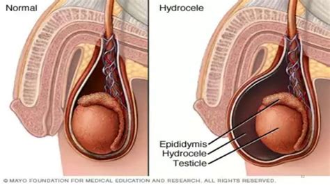 Scrotal And Testicular Swelling Pptx Infertility Reproductive Health