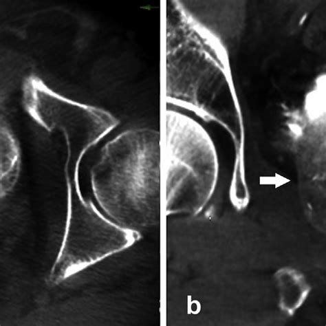 Complete Calcification Of The Prostatic Resection Cavity 5 Weeks After Download Scientific