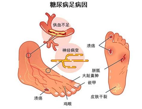 糖尿病足新型敷料（一） 知乎