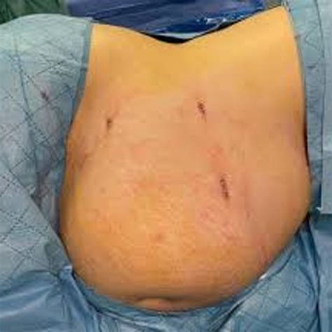 Appendectomy During Pregnancy Leading To Abdominal Wound Dehiscence